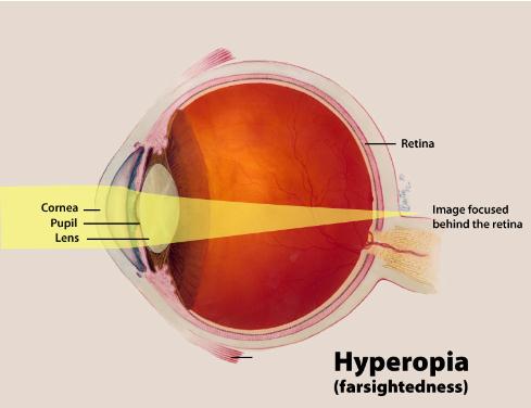 Long-sightedness (Hyperopia) - Symptoms and treatments for ...