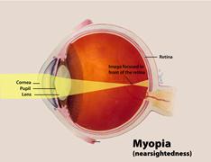 Short-sightedness (Myopia) - Symptoms and treatments for ...